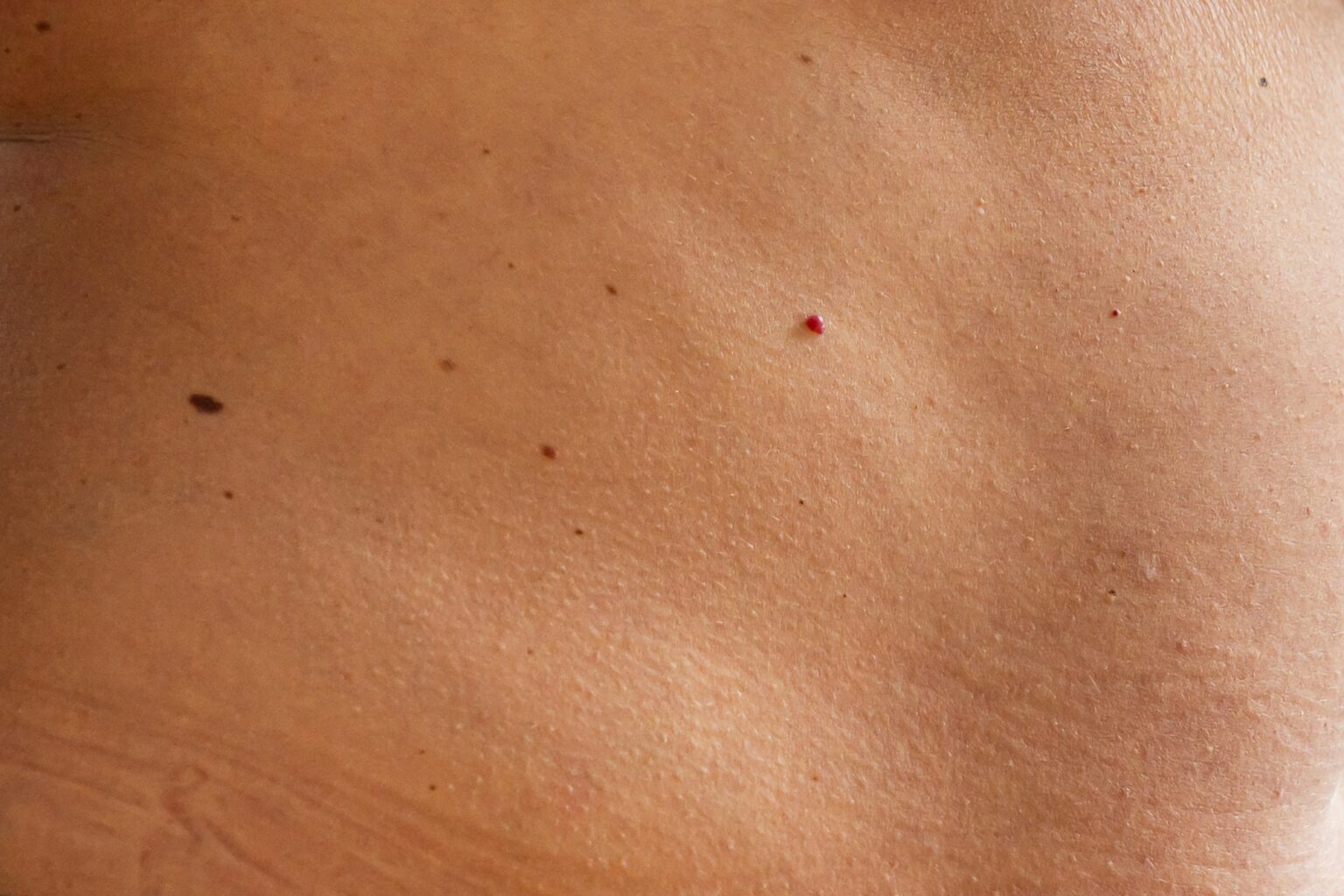 Angioma: Che Cos'è e Quando è Necessario Rimuoverlo - SalutePro